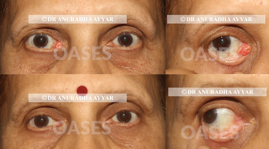 OASES Eye Care Center - Dr. Anuradha Ayyar